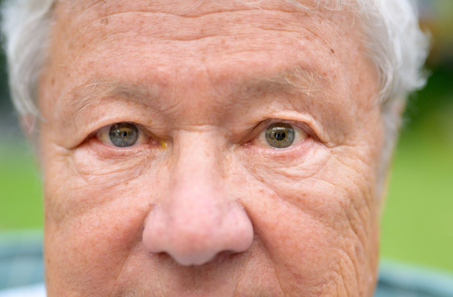 What Causes One Eye to Be Bigger than the Other?